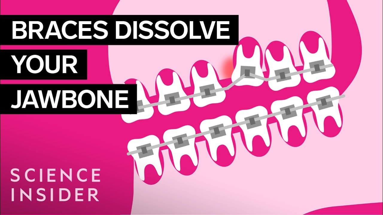 ≫ How Do Braces Work - The Dizaldo Blog!