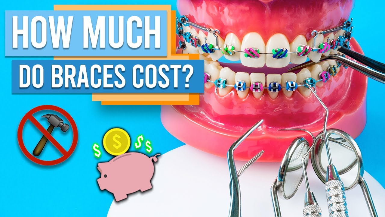 How Much Do Braces Cost – The Dizaldo Blog!