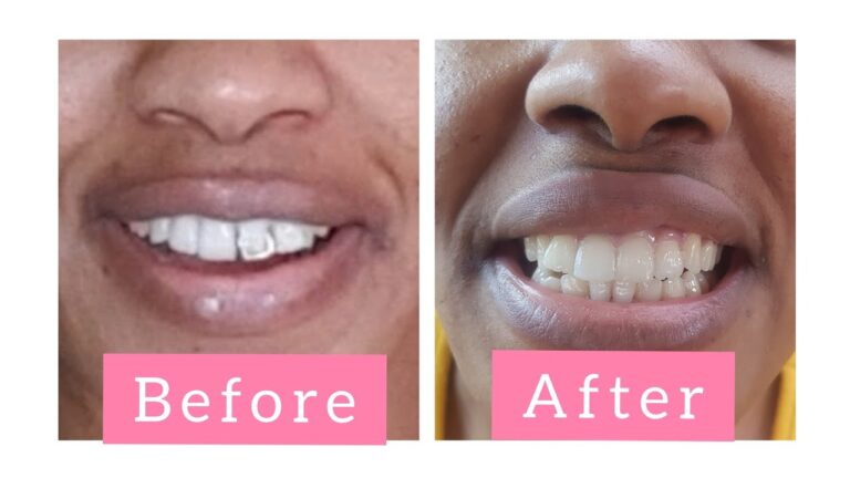 How Much Is A Gold Tooth In South Africa – The Dizaldo Blog!